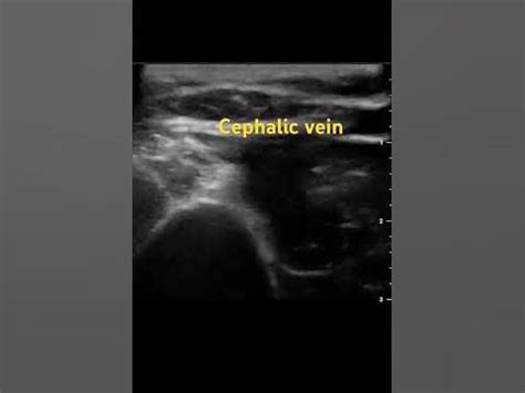 Céphalique Cefalic Cephalic Vein Anesthesia Anesthesiology