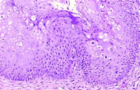 Cervical Intraepithelial Neoplasia 1 Cin 1 Low Grade Download Scientific Diagram