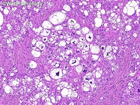 Atypical Lipomatous Tumorwell Diff Liposarcoma Lipoblasts