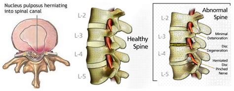 Spinal Decompression Stamford Ct Chiropractor Gabriel Chiropractic