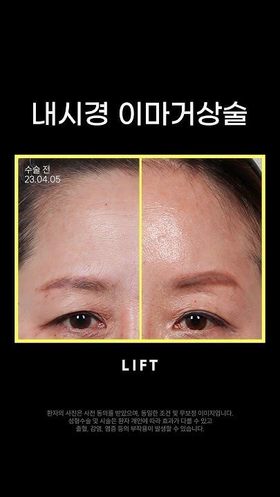 👀이제 힘들게 눈뜨지 마세요🙅 이마거상술 내시경이마거상 이마거상 수술전후 리프트성형외과 Youtube