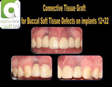 Buccal Soft Dr Mohammad Assaf الدكتور محمد عساف Facebook