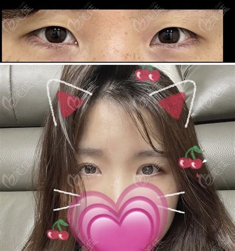 韩国迪美整形价格表双眼皮修复耳软骨鼻综合双鄂正颌手术费用都有最热整形行业新闻话题 美佳网