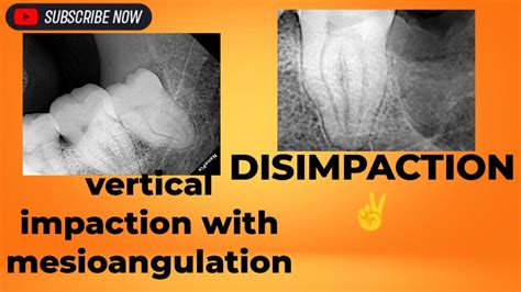 Disimpaction Of Vertical Impaction By Dr Sofi Irshad Youtube