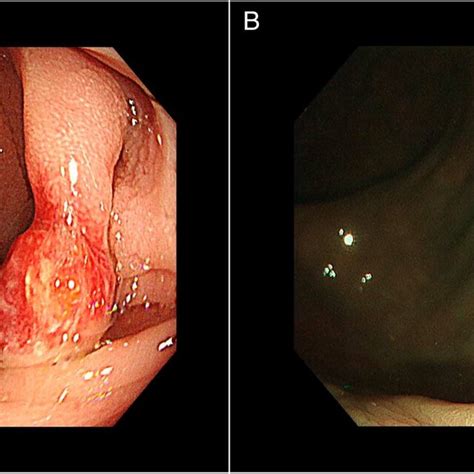 Colonoscopy Showing A Pedunculated Rectal Polyp Measuring 10 Mm In
