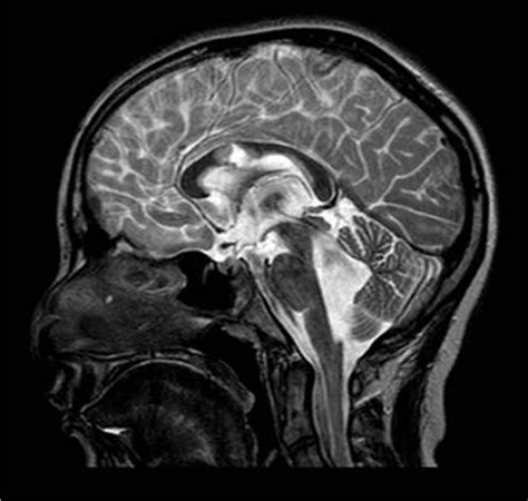 Sagittal T2 Mri Scan Showing “inverted” Flow At The Mesencephalic