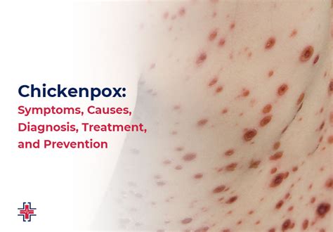 Chickenpox Symptoms Causes Diagnosis Treatment And Prevention Er