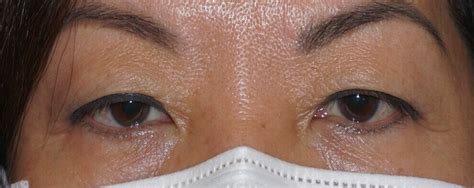 Ptosis Surgery In Singapore Droopy Eyelid Correction