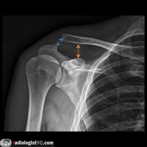 Grade 3 Acromioclavicular Joint Separation On X Ray Status Post Fall Rradiology