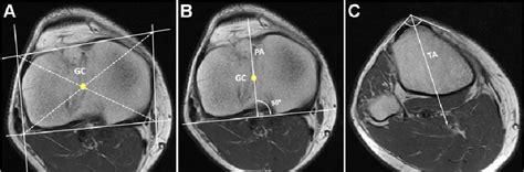 Figure 1 From Tibial Tuberosity Rotation In Patients With Patellar Instability Versus Age And Figure 1 From Tibial Tuberosity Rotation In Patients With Patellar Instability Versus Age And