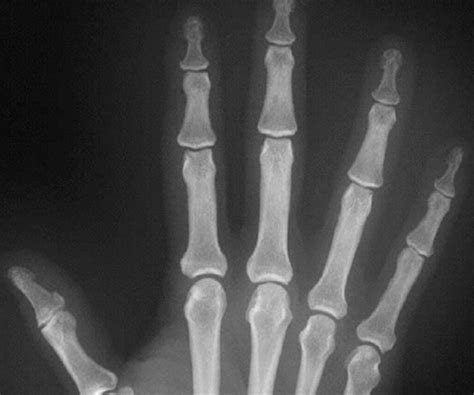 Untitled — Perianal Pyramidal Protrusion Symptoms Causes