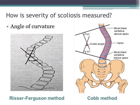 Cobb Angle Measurement And Treatment Guidelines Mkdokr