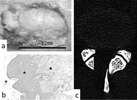 Patient 4 A Macroscopic Photograph Of The Surface Of The Tumor The