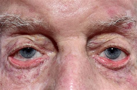 Ectropion All About Vision