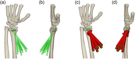 All Inside Physeal Bar Resection For Partial Physeal Arrest Of The