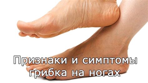 Признаки и симптомы грибка на ногах Youtube