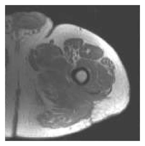 Axial Mri With Contrast A Showing A Soft Tissue Sarcoma Involving Download Scientific