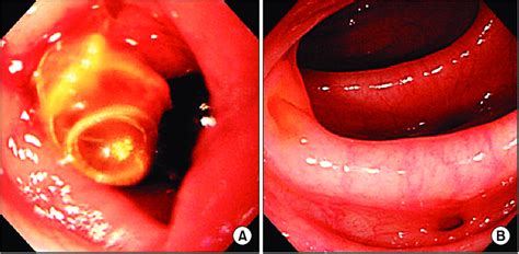 Colonoscopy Showed A Sigmoid Colon Penetration Of Embolic Coil And
