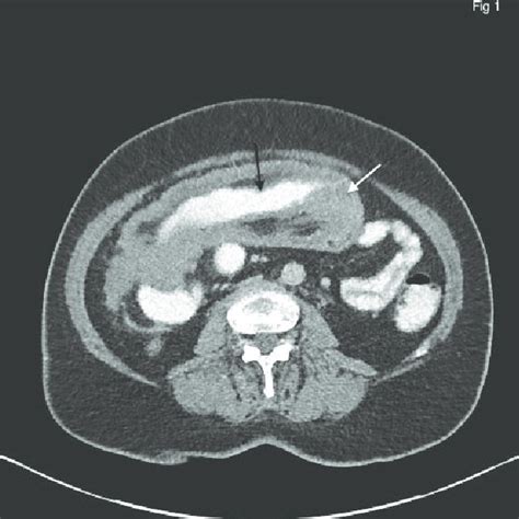 Ct Scan Small Bowel Intussusception Black Arrow Download Scientific