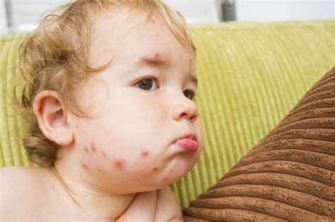 Varicela en bebés y recién nacidos los bebés pueden enfermarse y la