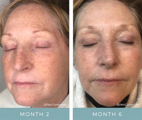 Chemotherapy Rash Before After Neogenesis Skin Care