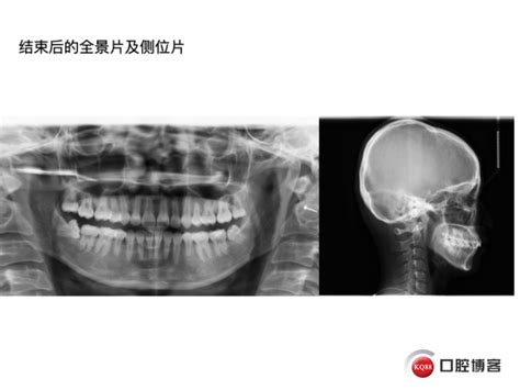 骨性II类安氏I类减数4个第一前磨牙矫治病例 Dr ZK1的博客 KQ88口腔博客