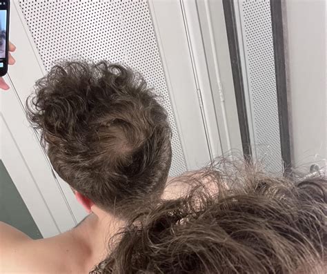6 Months Of Using Hims Finasteride And Minoxidil Spray Rmenlonghair