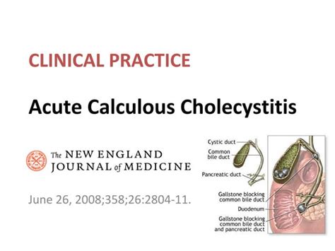 Acute Calculous Cholecystitis Ppt
