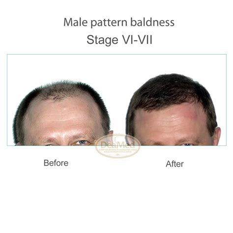 Gallery Deamed Hair Transplantation Results