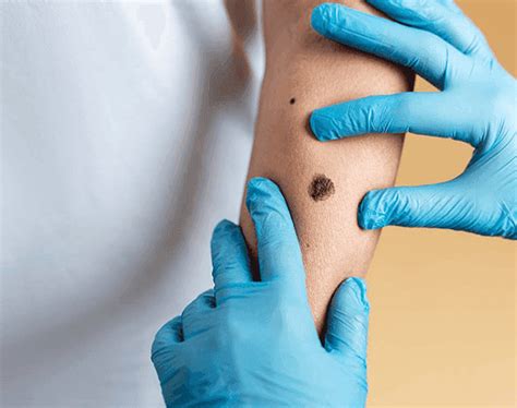 Punch Skin Biopsy In Jaipur India Apex Hospitals