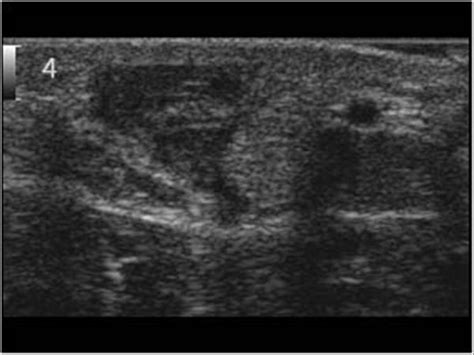 Musculoskeletal Joints And Tendons 64 Fingers Case 645 Tumors Ultrasound Cases