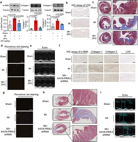 Downregulation Of Pfkfb3 Attenuated Post Mi Cardiac Fibrosis In Mice