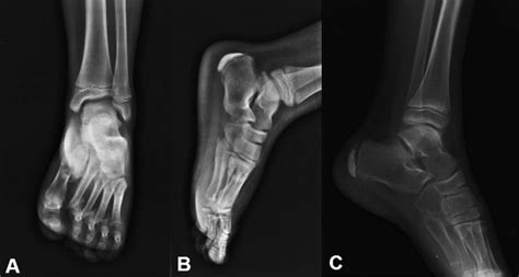 X Ray Examination In Different Projections In A Case Of Sever Blanke