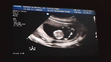 Ultrassom Sexo Do Baby 14 Semanas BabyIsis YouTube