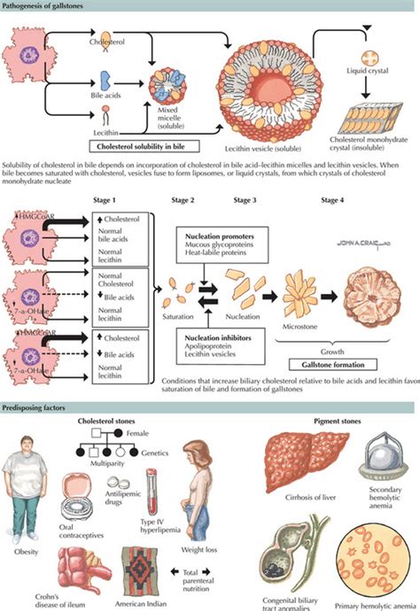 Cholelithiasis Clinical Gate