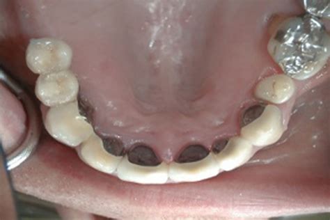 Bruxism Erosion Severe Wear L Teeth Grinding Repairs Dublin