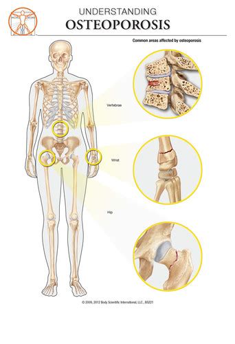 Osteoporosis Anatomical Wall Chart Bsi Catalog