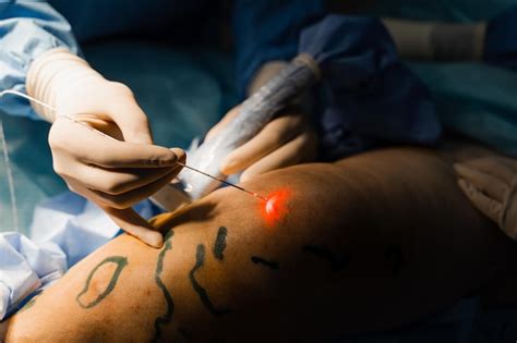 Premium Photo Endovenous Laser Coagulation For Treatment Varicose