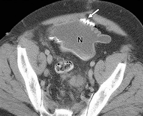 Neobladder Ultrasound