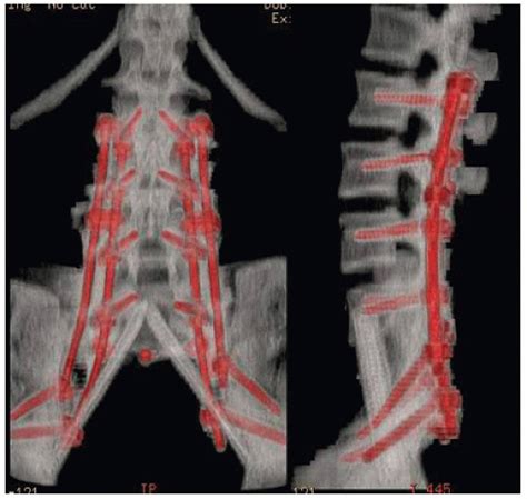 Sacrectomy Musculoskeletal Key