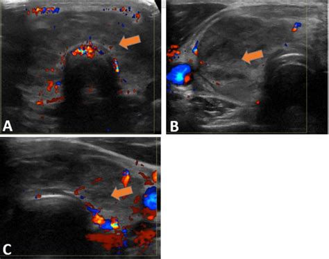Thyroid Doppler Ultrasound Us Showing Hypo Download Scientific Diagram