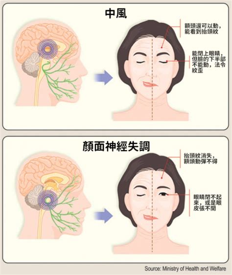 腦中風有 4 大前兆！注意 3 種暈眩症狀，有異狀就送醫 Heho健康