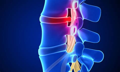 Лечение на дискова херния дископатия — Medconsult Bg