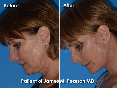 Facelift Photos Before And After Dr James Pearson Facial Plastic Surgery