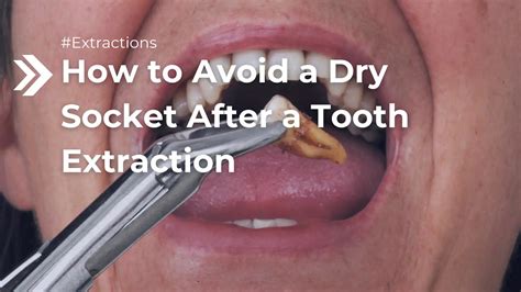 How To Avoid A Dry Socket After A Tooth Extraction