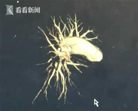 男子久坐不起險猝死 一查竟得肺栓塞 每日頭條