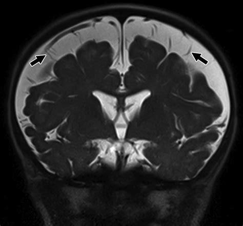 Macrocephaly Mri
