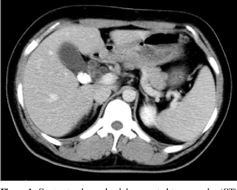 Figure 1 From Case Report Of A Double Common Bile Duct With Gallstone