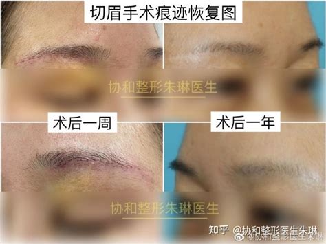 今日案例给大家展示一下切眉手术各个阶段痕迹恢复情况 知乎