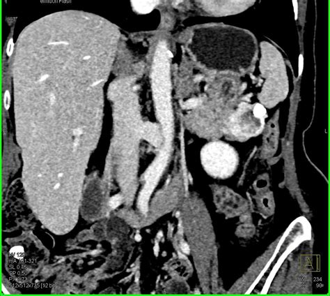 Pancreatic Neuroendocrine Tumor Pnet Tail Of Pancreas Pancreas